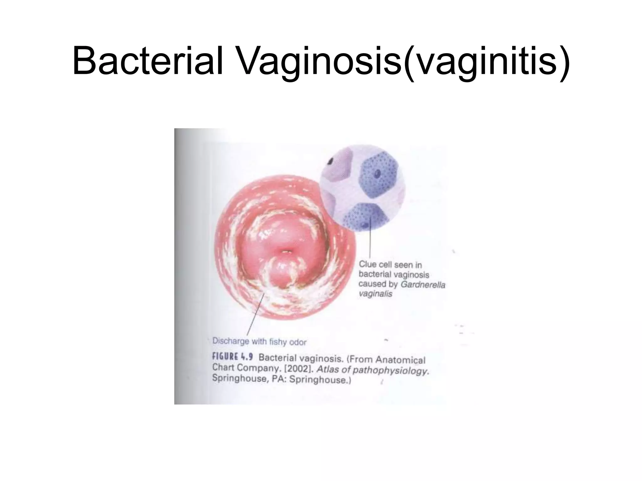 11.infectious disease of genitalia & sexual transmitted infections ...