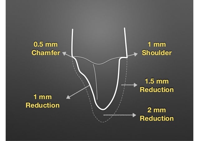11-13 PFM preparation