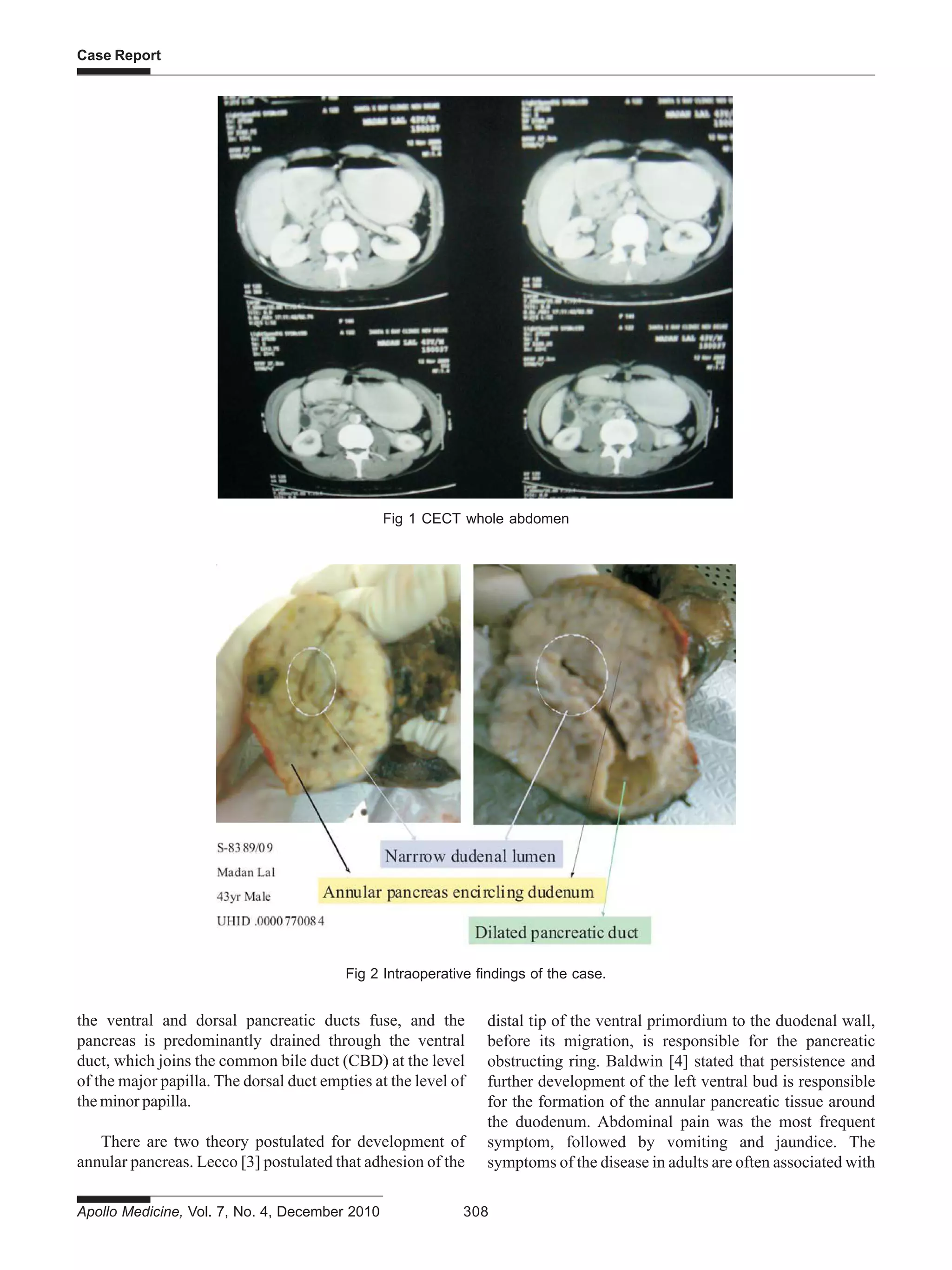 Annular Pancreas: An Unusual Presentation | PDF