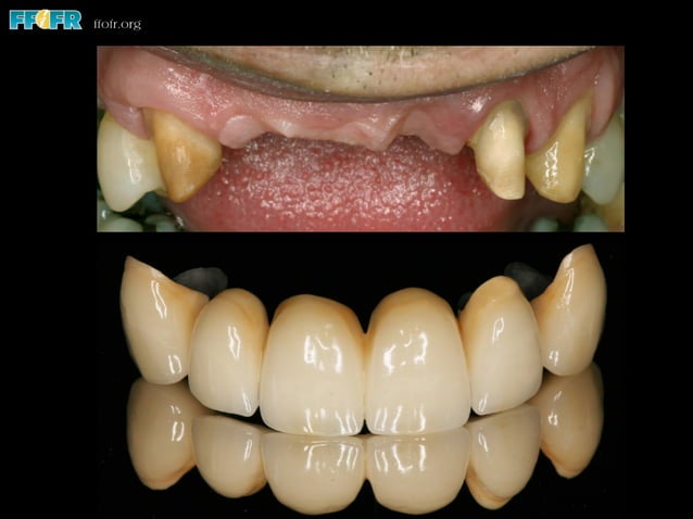 11.tp & fpd designs | PDF | Dental Health | Diseases and Conditions