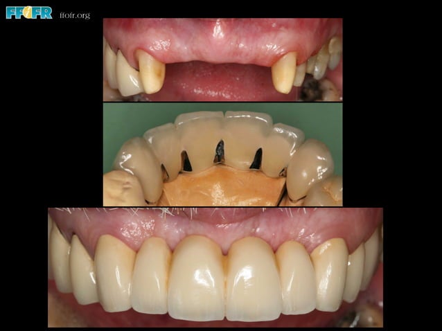 11.tp & fpd designs | PDF | Dental Health | Diseases and Conditions