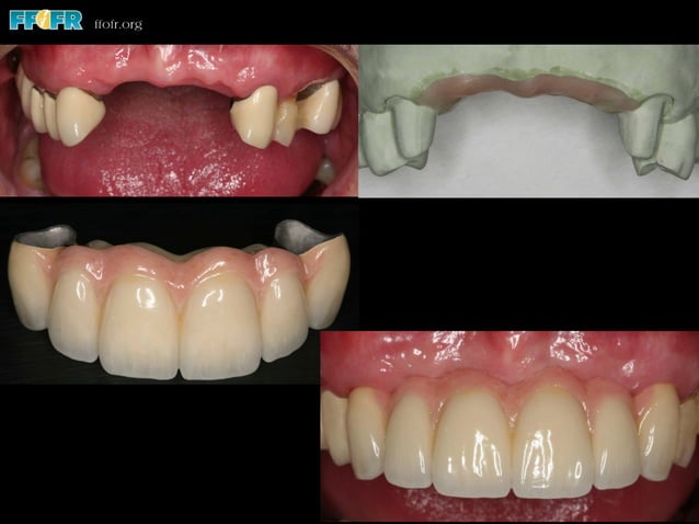 11.tp & fpd designs | PDF | Dental Health | Diseases and Conditions