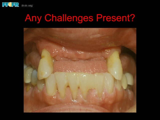 11.tp & fpd designs | PDF | Dental Health | Diseases and Conditions