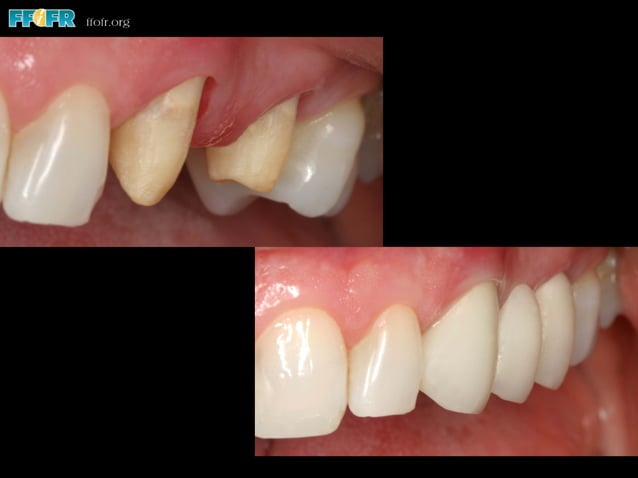 11.tp & fpd designs | PDF | Dental Health | Diseases and Conditions