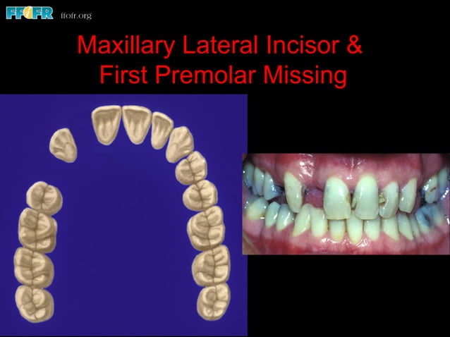 11.tp & fpd designs | PDF | Dental Health | Diseases and Conditions