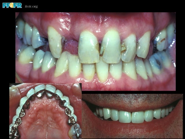 11.tp & fpd designs | PDF | Dental Health | Diseases and Conditions