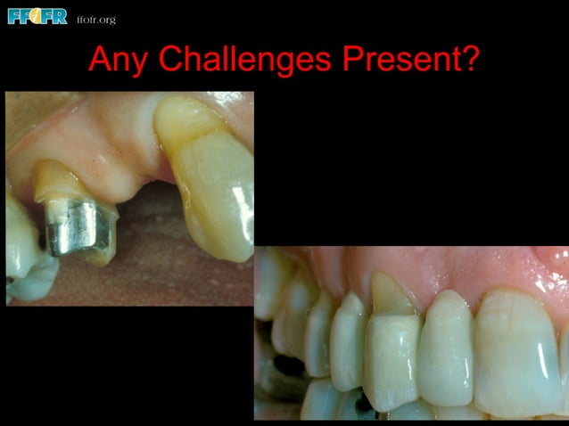 11.tp & fpd designs | PDF | Dental Health | Diseases and Conditions
