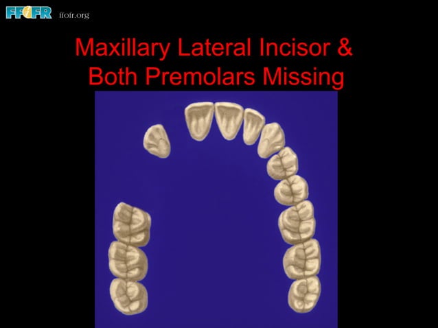 11.tp & fpd designs | PDF | Dental Health | Diseases and Conditions