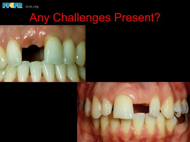11.tp & fpd designs | PDF | Dental Health | Diseases and Conditions