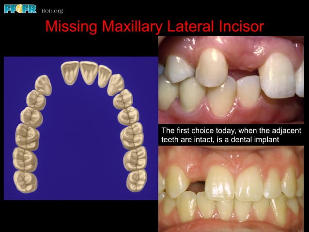 11.tp & fpd designs | PDF | Dental Health | Diseases and Conditions