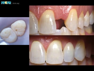 Anterior Fixed Partial Denture