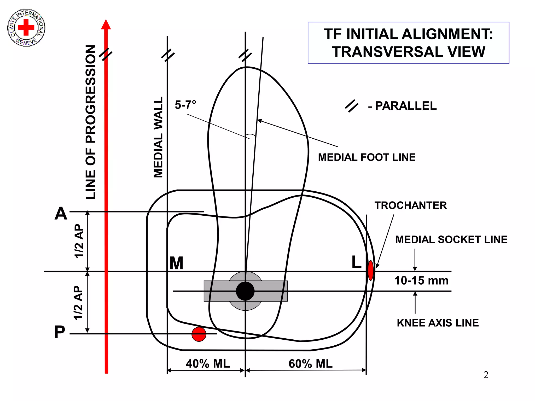 Transfemoral Initial Alignment | PPTX