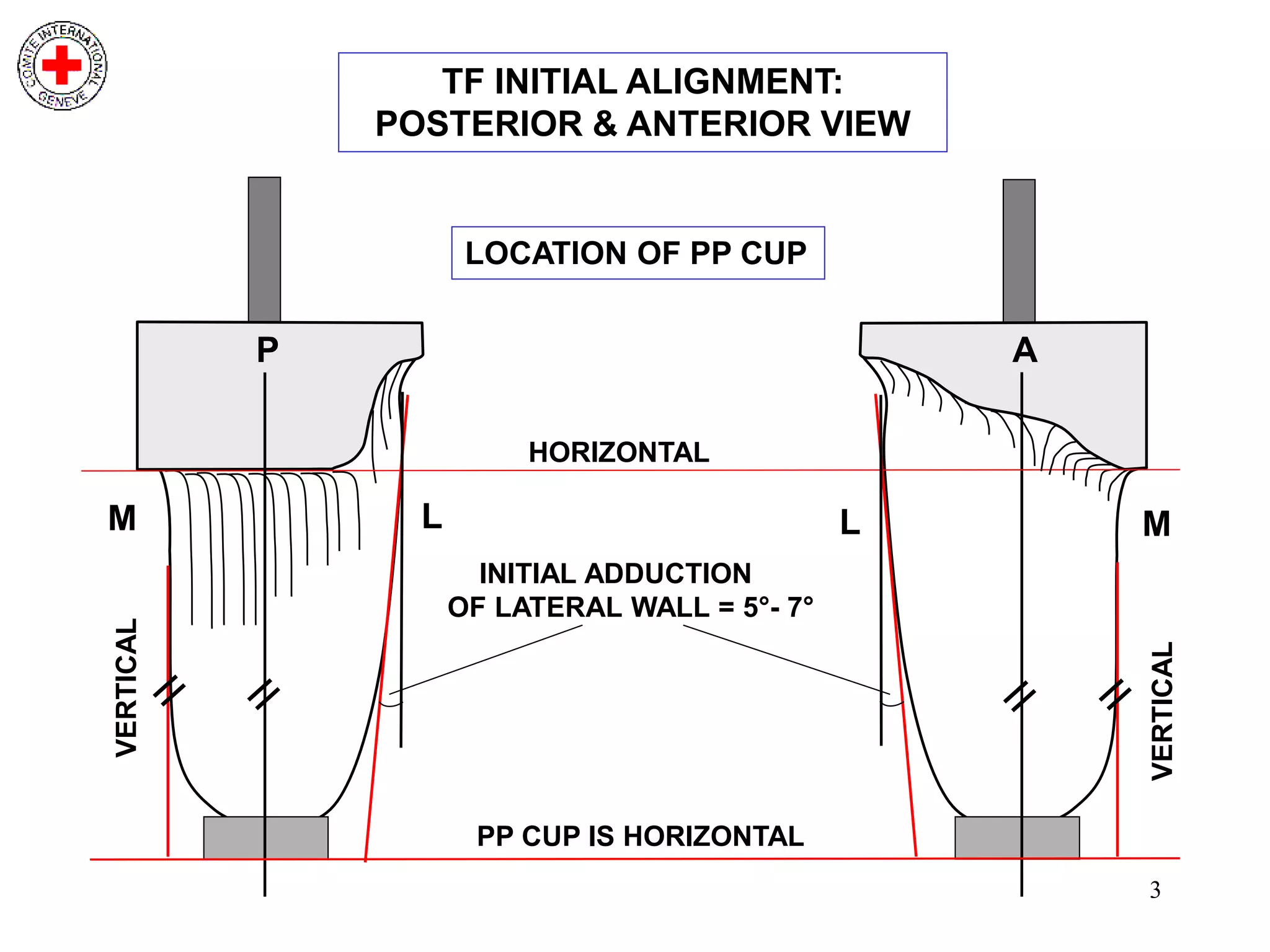 Transfemoral Initial Alignment | PPTX
