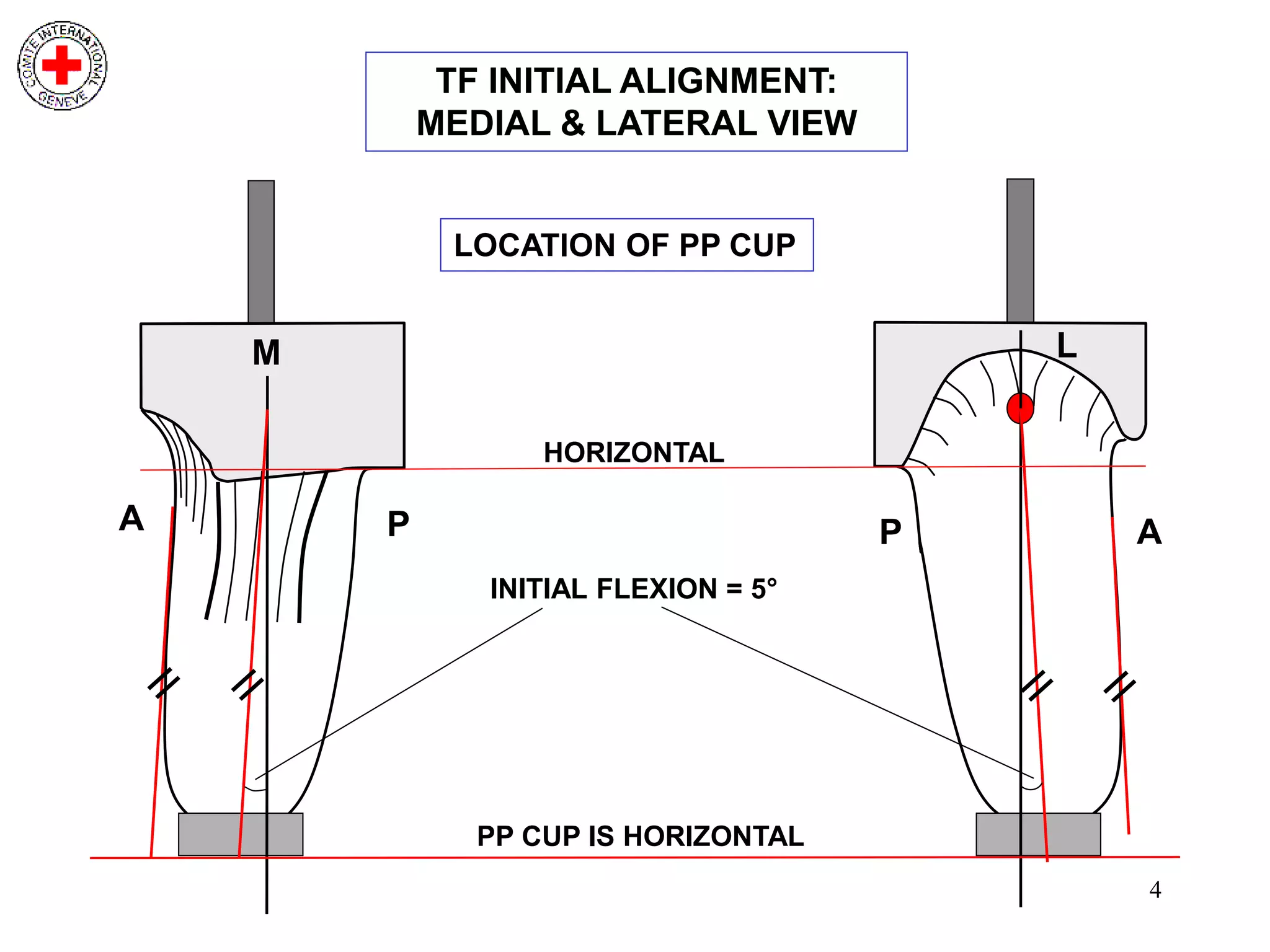 Transfemoral Initial Alignment | PPTX