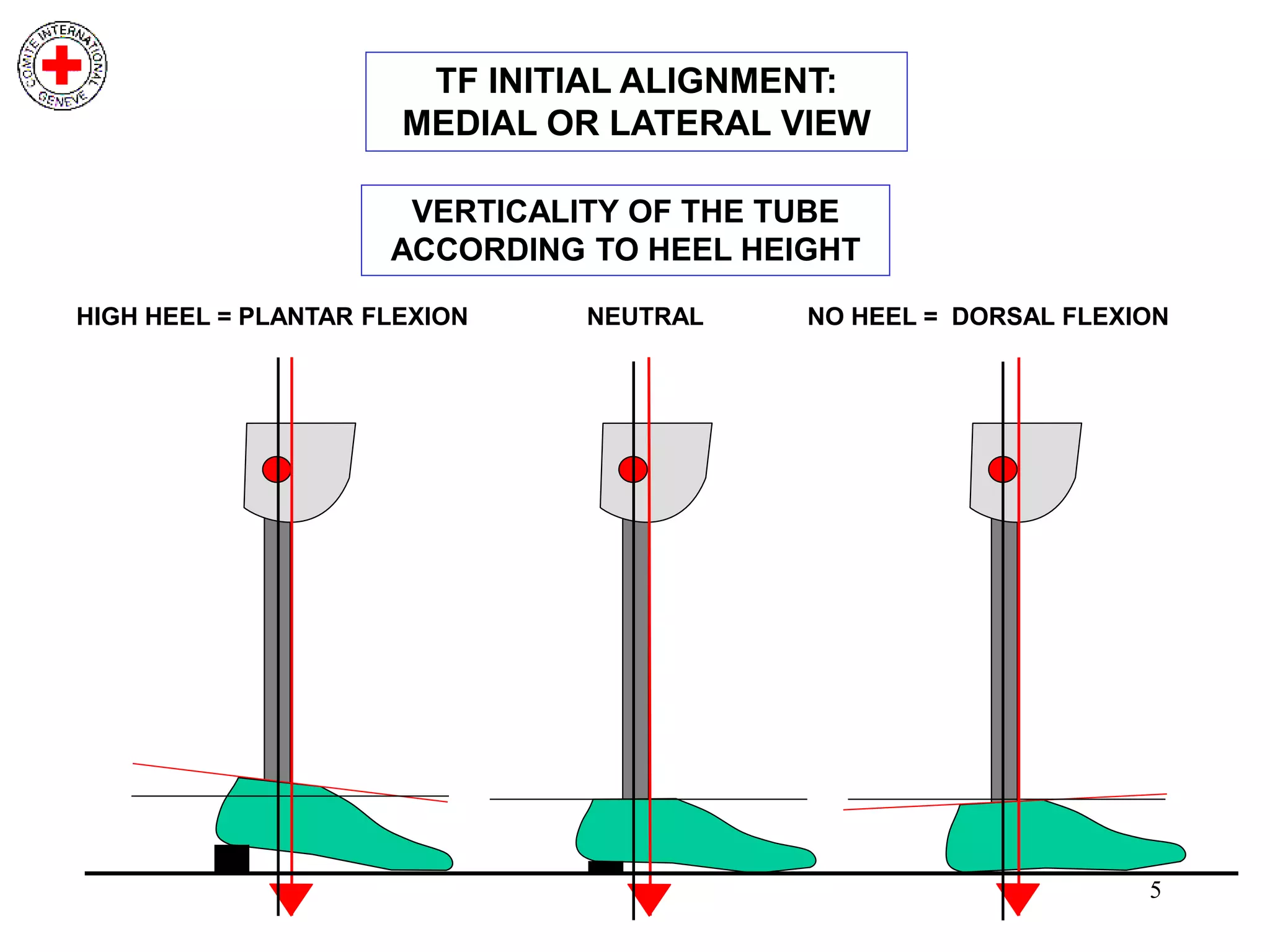 Transfemoral Initial Alignment | PPTX