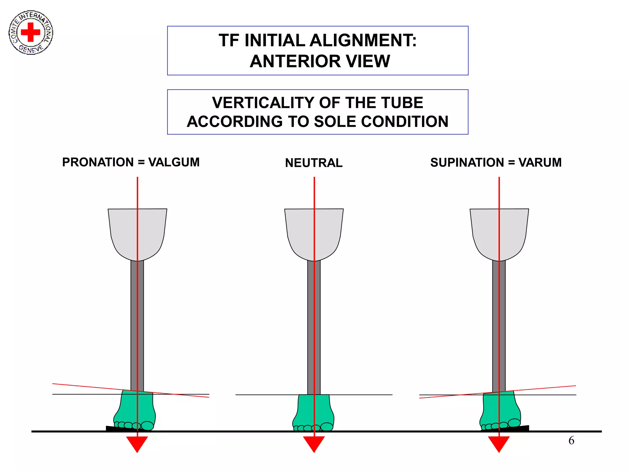 Transfemoral Initial Alignment | PPTX