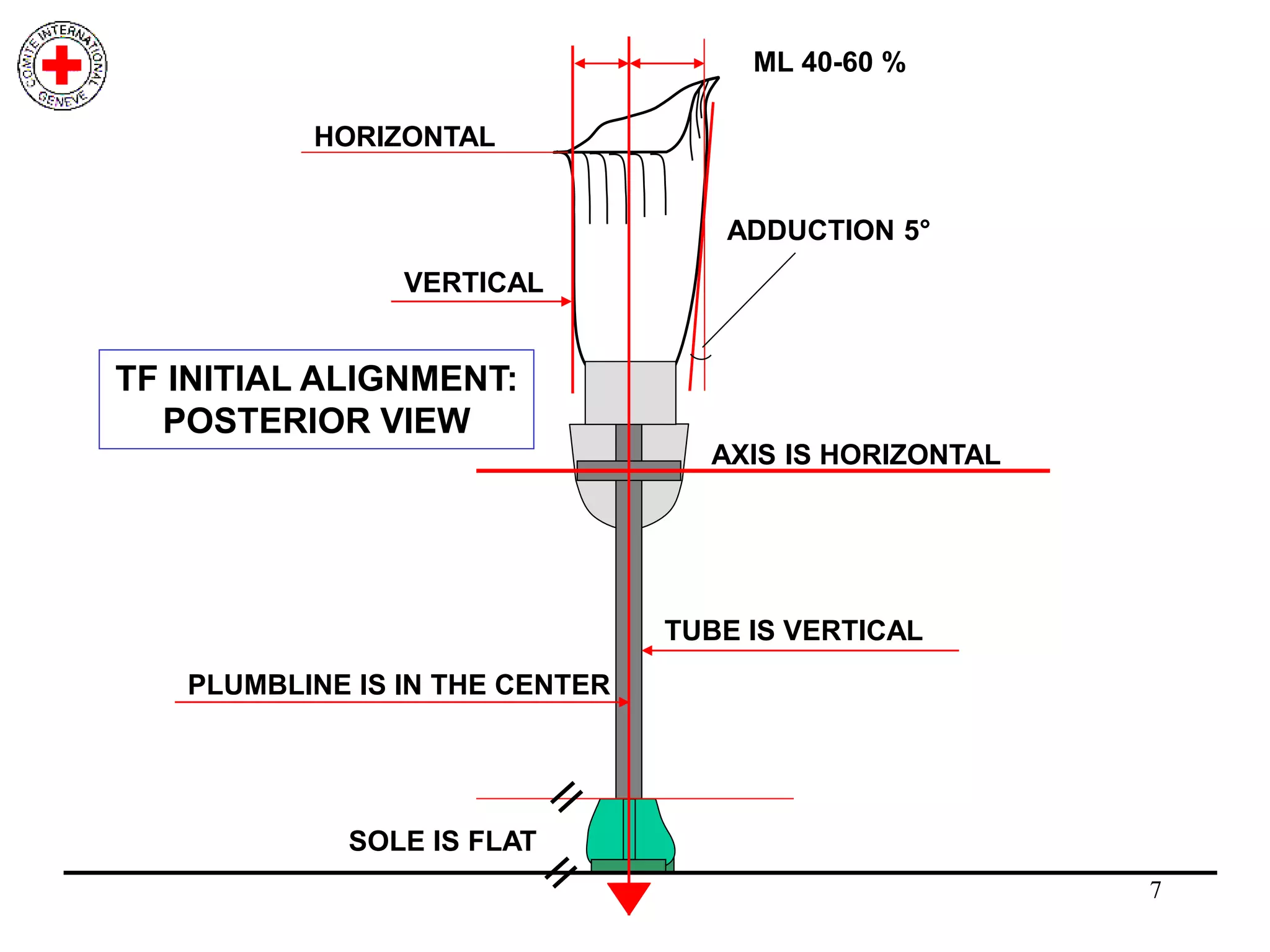 Transfemoral Initial Alignment | PPTX
