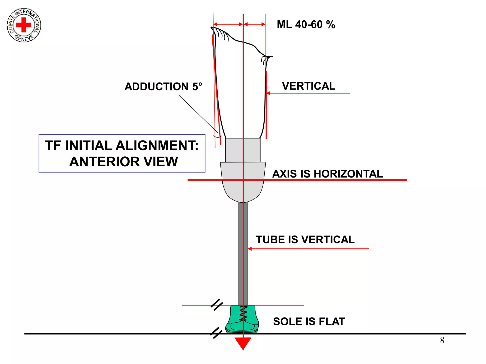 Transfemoral Initial Alignment | PPTX