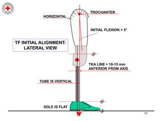 Transfemoral Initial Alignment | PPTX