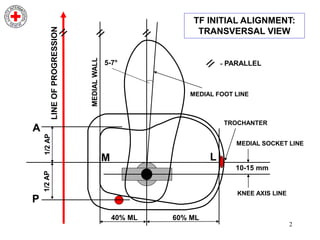 Transfemoral Initial Alignment | PPTX