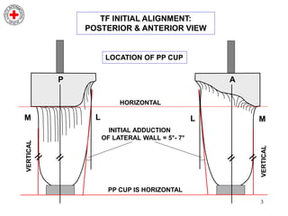 Transfemoral Initial Alignment | PPTX