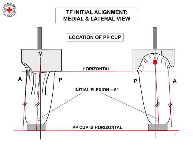 Transfemoral Initial Alignment | PPTX | Death, Injury, or Military ...