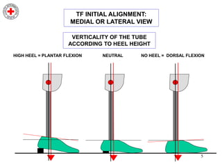Transfemoral Initial Alignment | PPTX