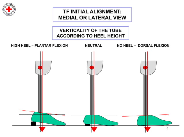 Transfemoral Initial Alignment | PPTX | Death, Injury, or Military ...