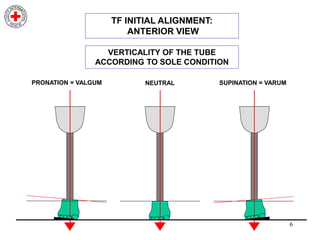 Transfemoral Initial Alignment | PPTX