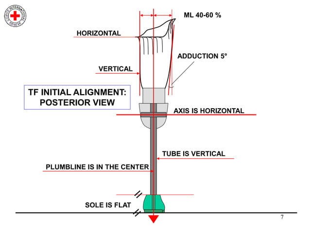 Transfemoral Initial Alignment | PPTX | Death, Injury, or Military ...