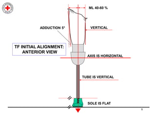 Transfemoral Initial Alignment | PPTX