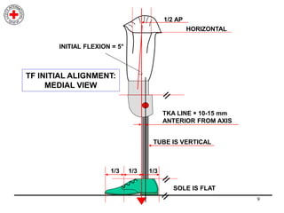 Transfemoral Initial Alignment | PPTX