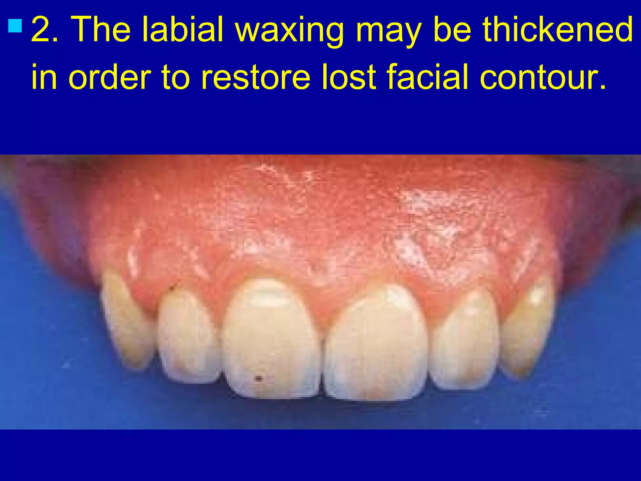 11.complete denture wax‐up and flasking procedure | PPT