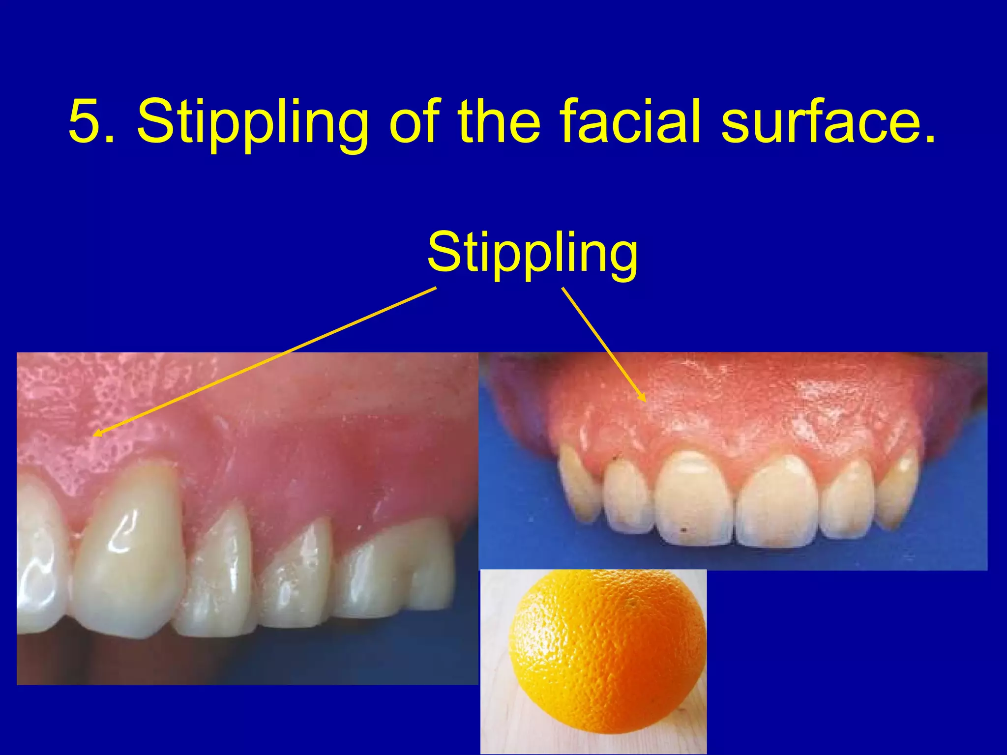 11.complete denture wax‐up and flasking procedure | PPT