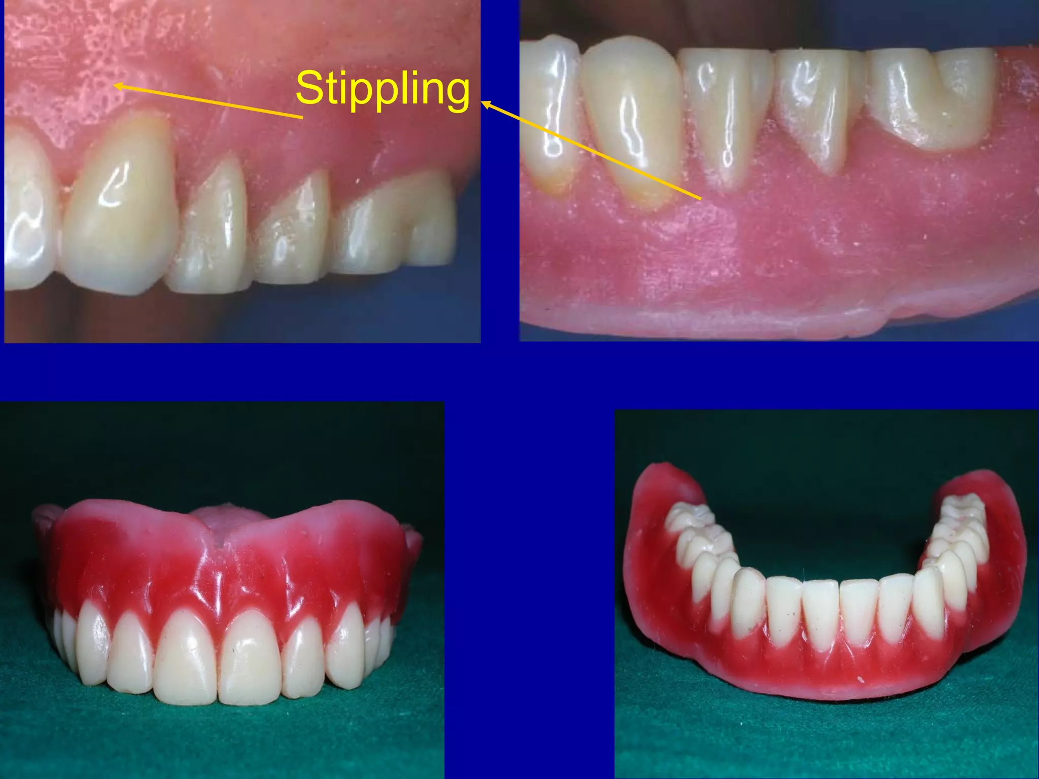 11.complete denture wax‐up and flasking procedure | PPT