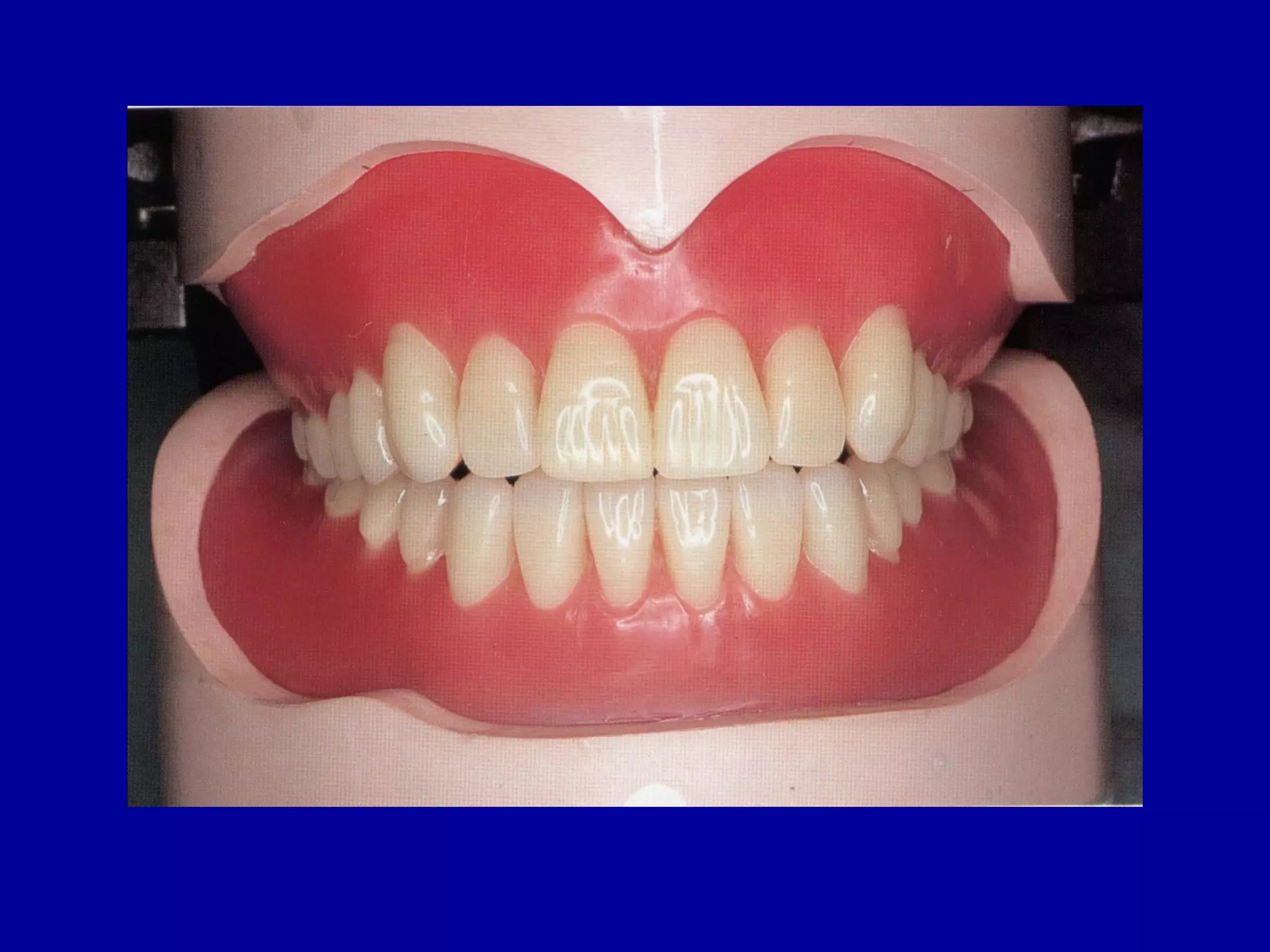 11.complete denture wax‐up and flasking procedure | PPT