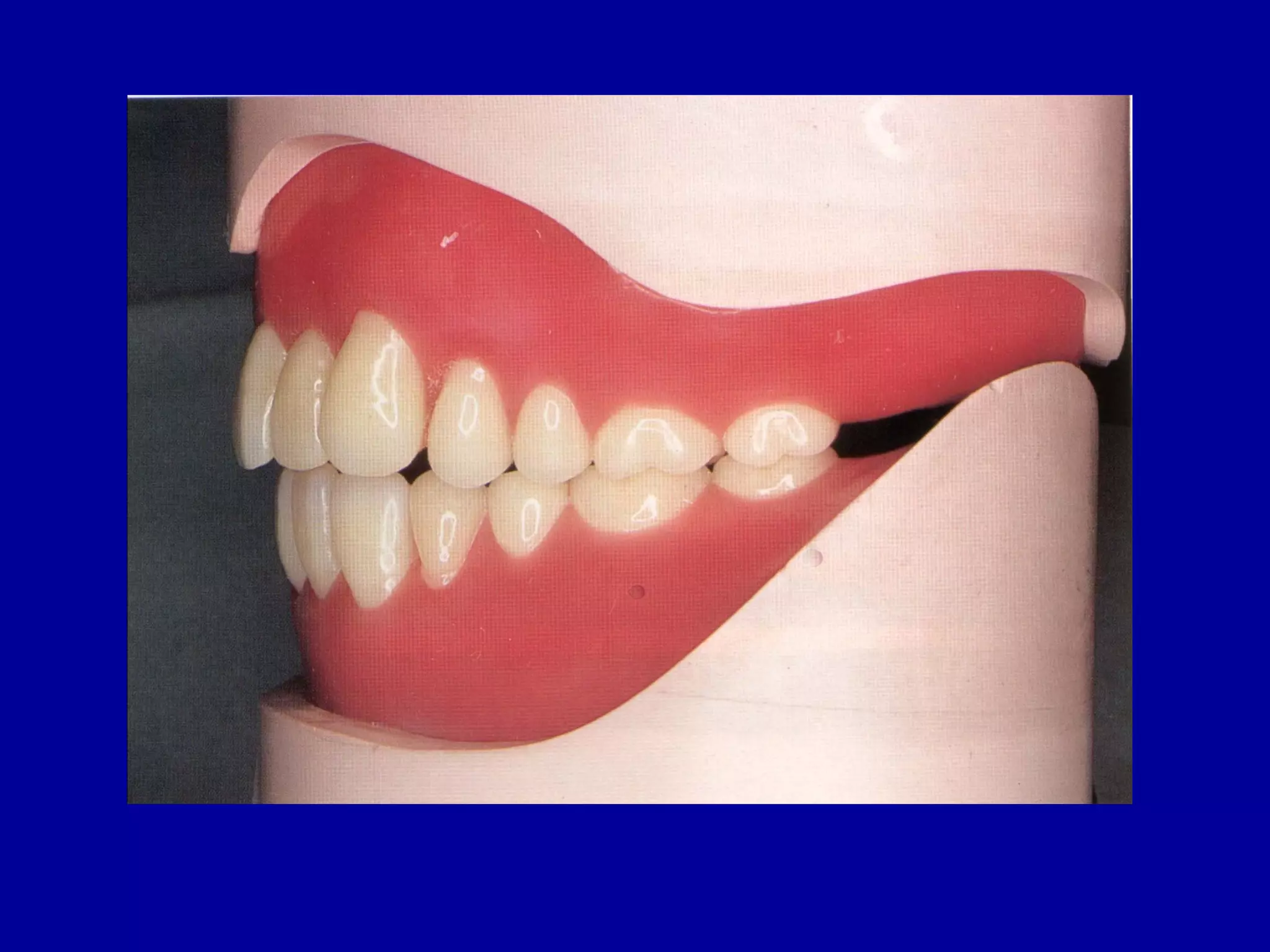 11.complete denture wax‐up and flasking procedure | PPT