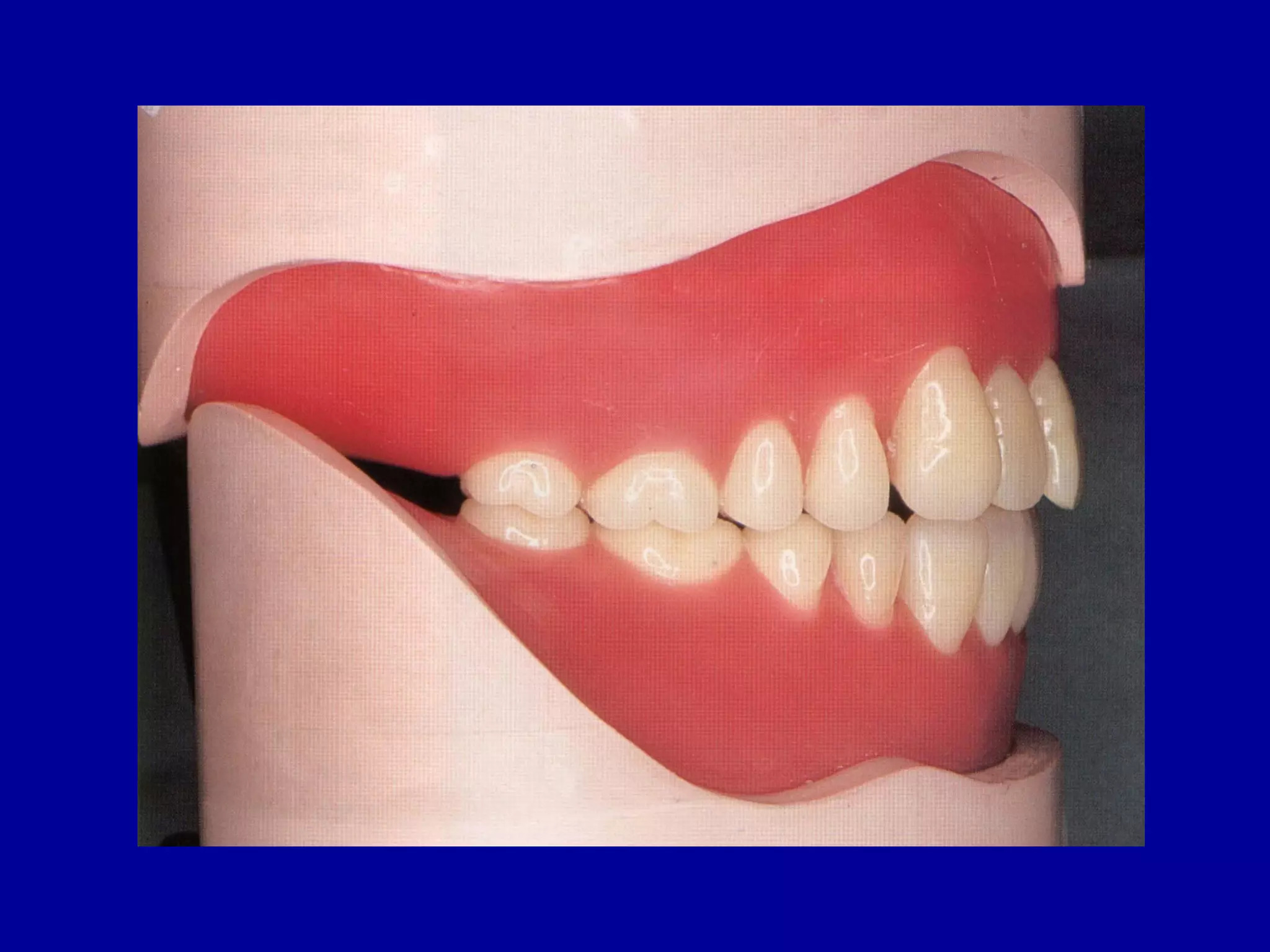 11.complete denture wax‐up and flasking procedure | PPT