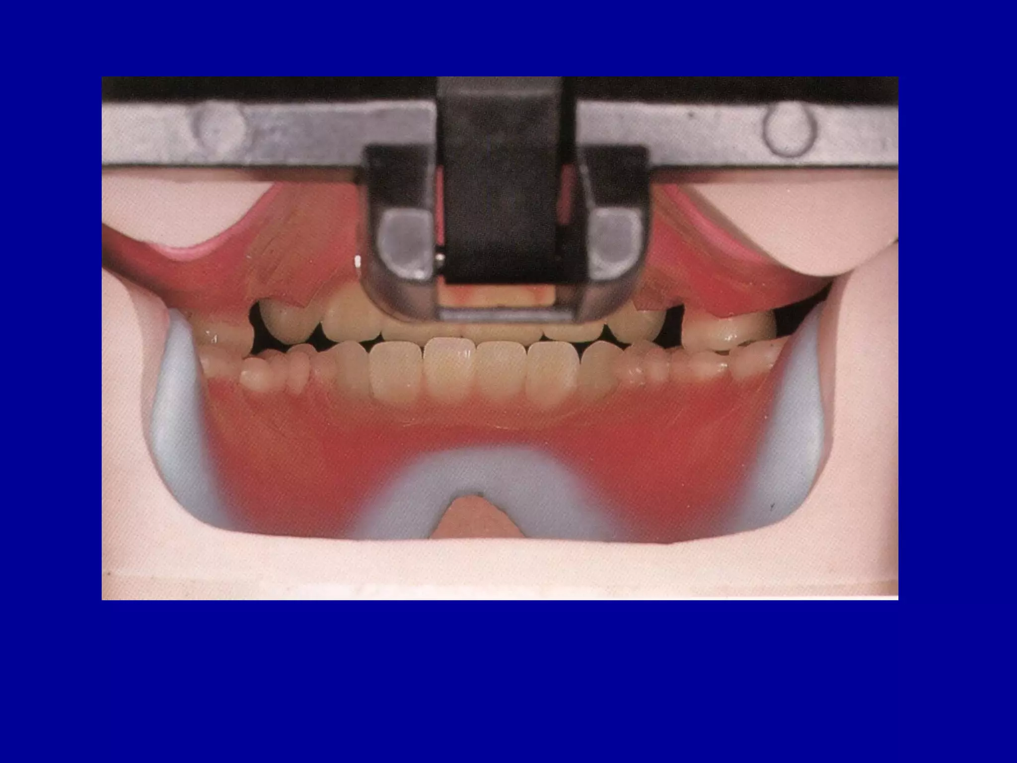 11.complete denture wax‐up and flasking procedure | PPT
