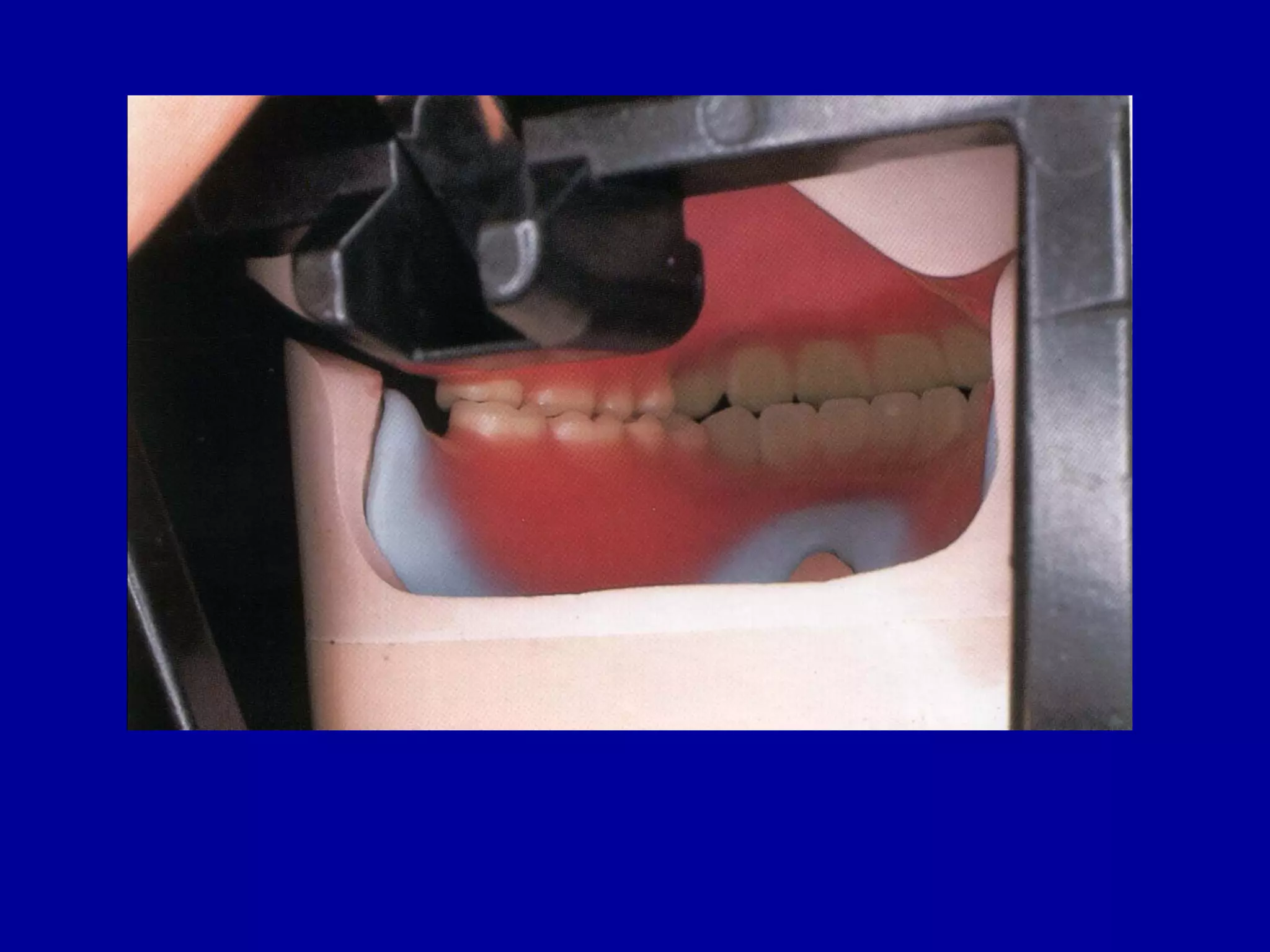 11.complete denture wax‐up and flasking procedure | PPT