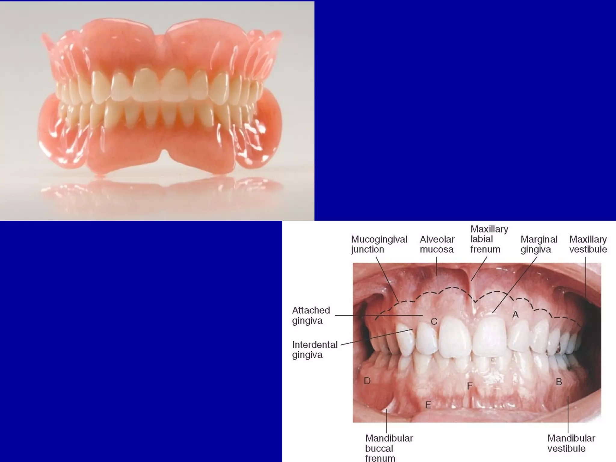 11.complete denture wax‐up and flasking procedure | PPT