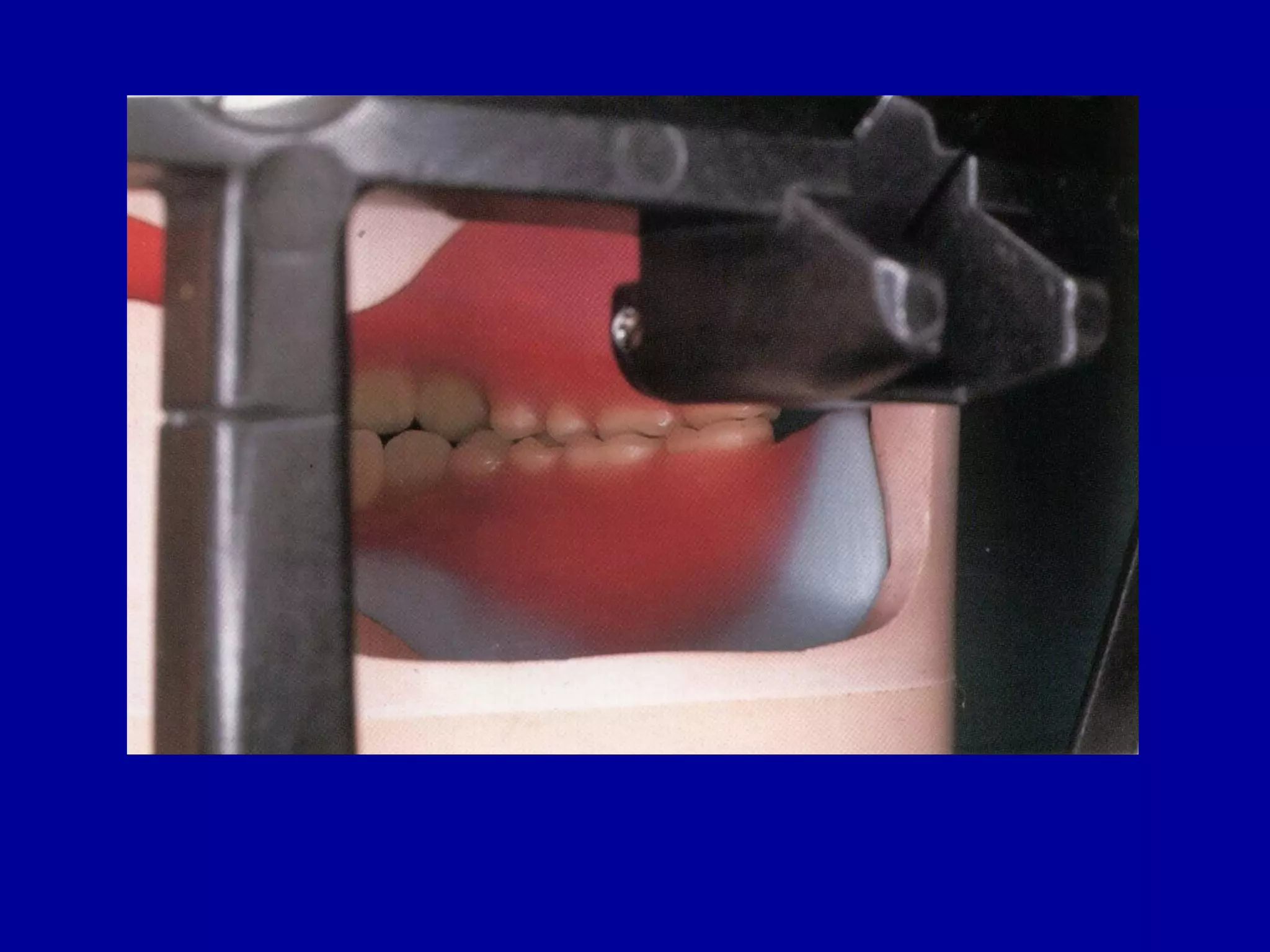 11.complete denture wax‐up and flasking procedure | PPT