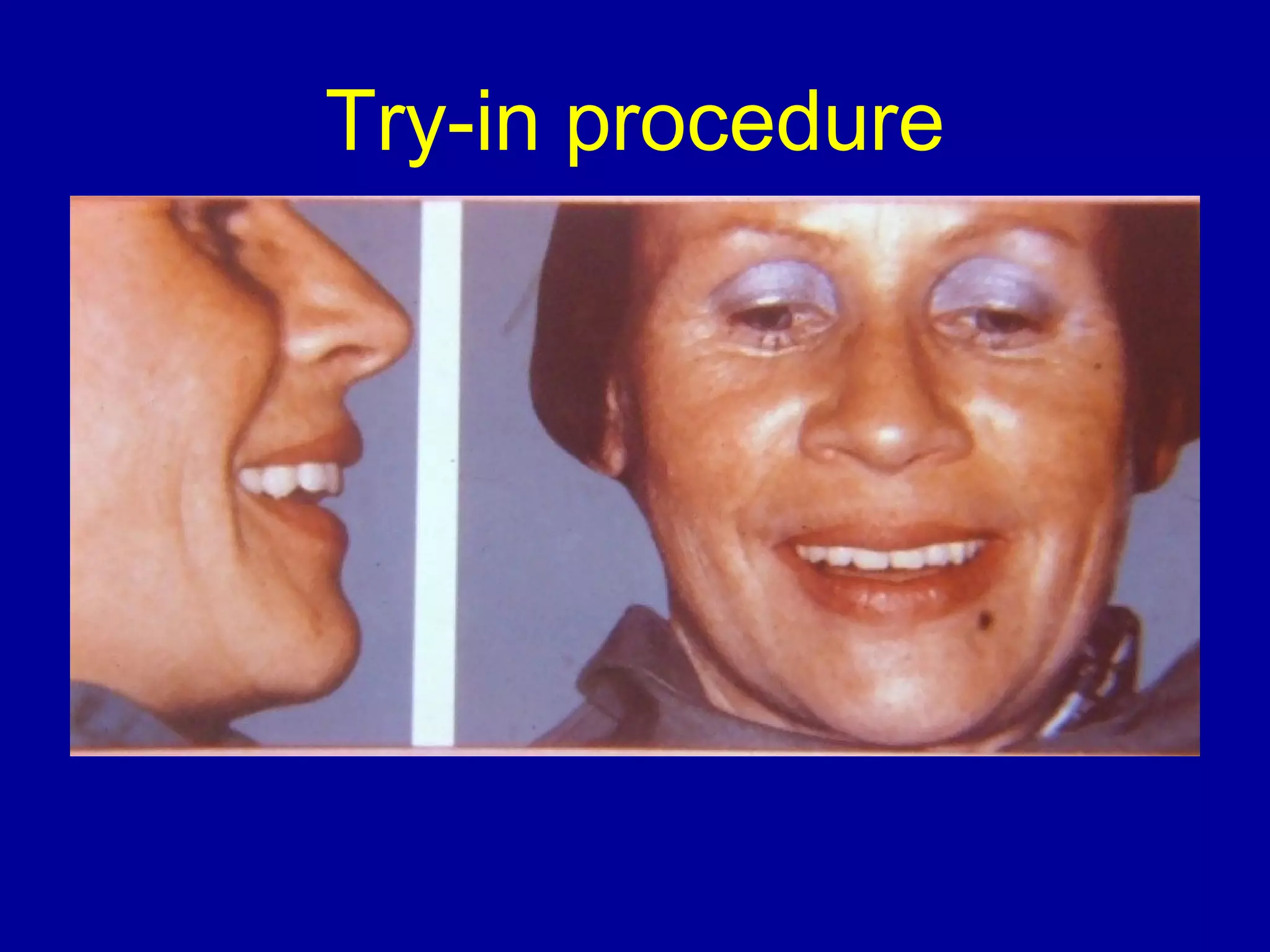 11.complete denture wax‐up and flasking procedure | PPT