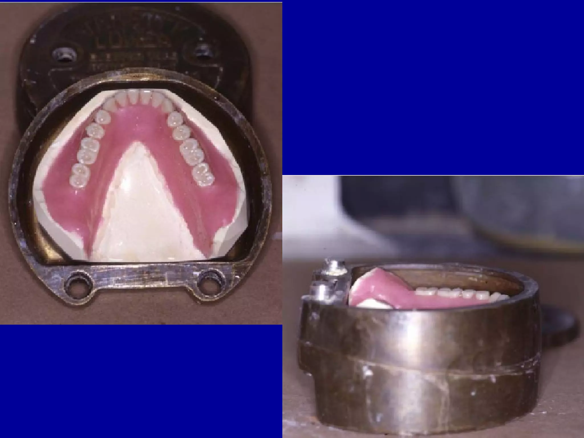 11.complete denture wax‐up and flasking procedure | PPT