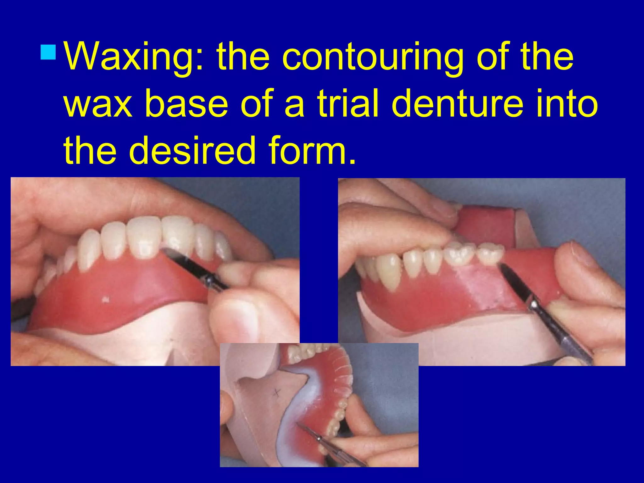 11.complete denture wax‐up and flasking procedure | PPT