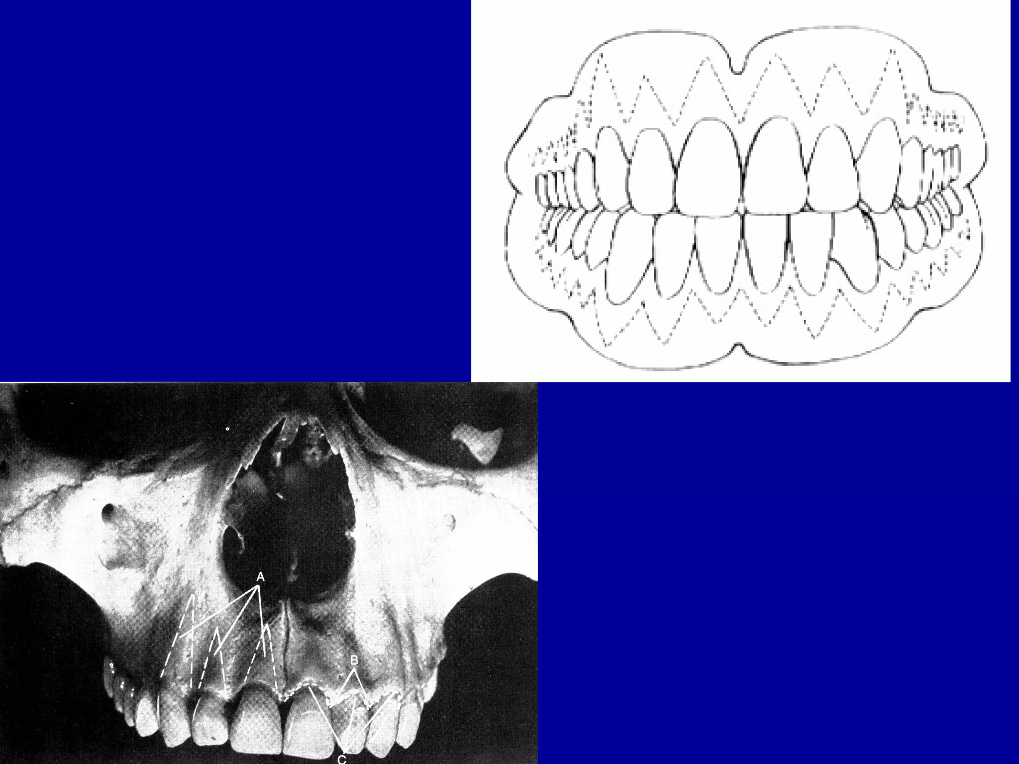 11.complete denture wax‐up and flasking procedure | PPT