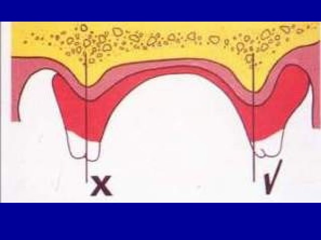 11.complete denture wax‐up and flasking procedure | PPT