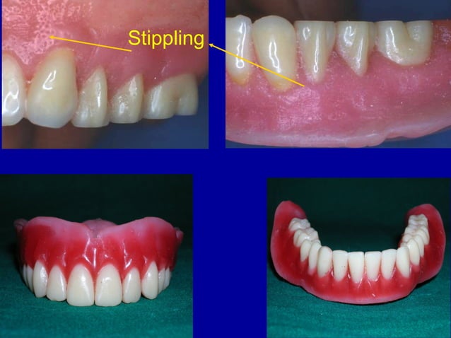 11.complete denture wax‐up and flasking procedure | PPT