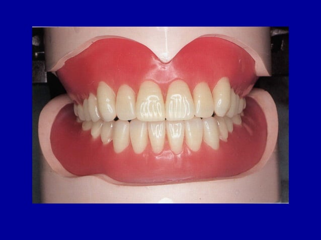 11.complete denture wax‐up and flasking procedure | PPT