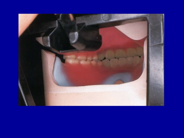 11.complete denture wax‐up and flasking procedure | PPT